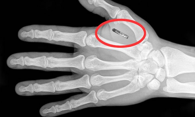 Sweden’s human microchip craze a warning for privacy-loving Americans ...